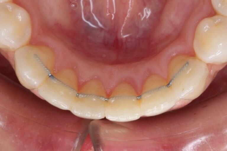 Retainers - Wang Smiles